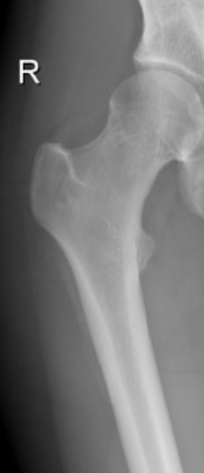 A year after my freak fractured femur, a condition with a complicated ...